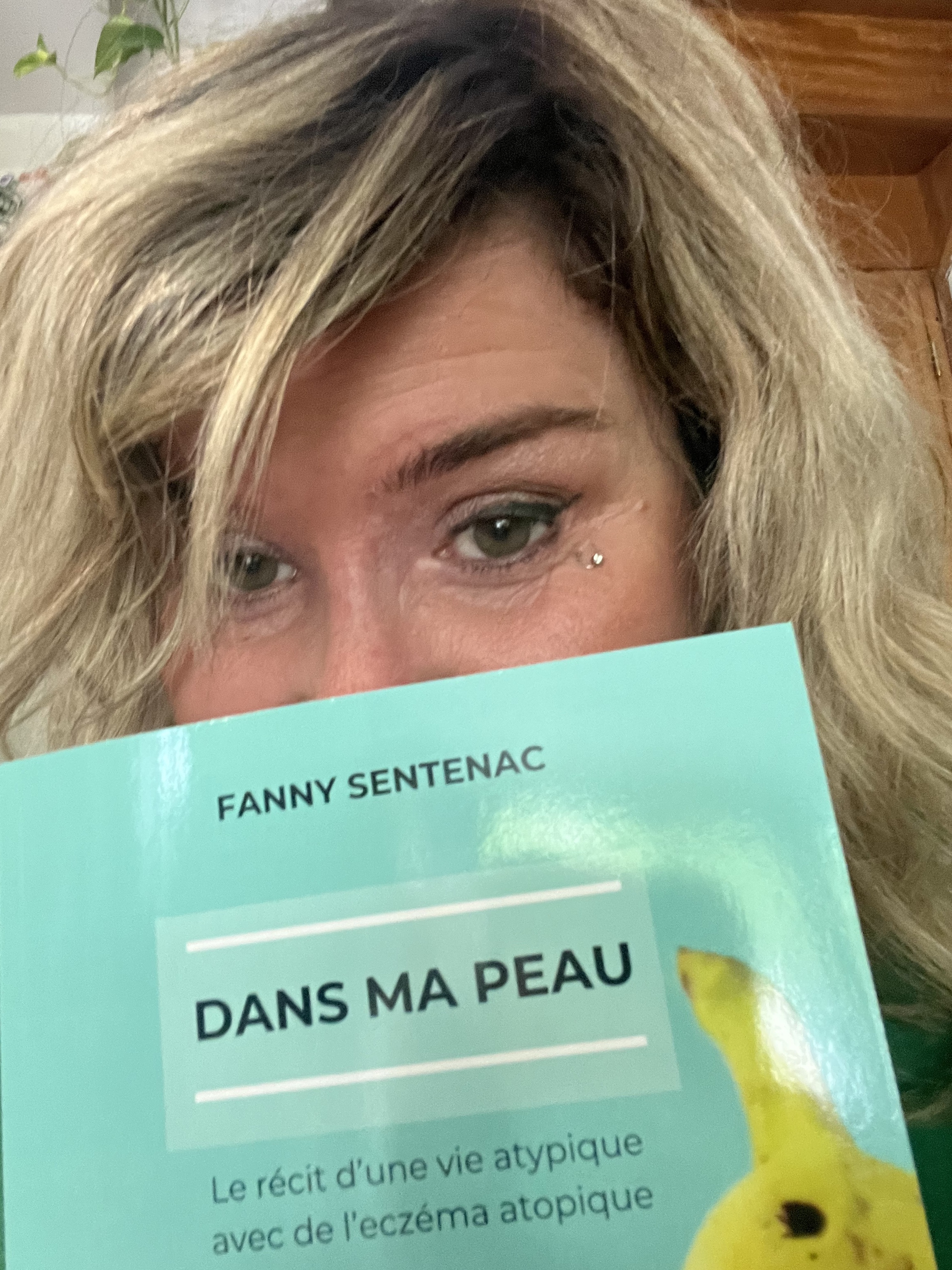 Dans ma peau : aider à mieux vivre avec l'eczéma atopique - Ulule